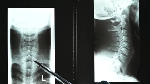 Doctor pointing at neck x-ray or CT scan... | Stock Video | Pond5