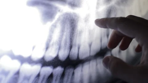 doctor's hand analyzing x-ray scan of a ... | Stock Video | Pond5
