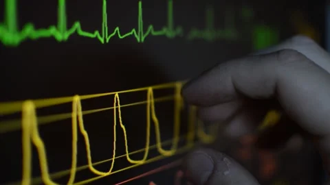 doctor's hand monitoring ekg electrocard... | Stock Video | Pond5