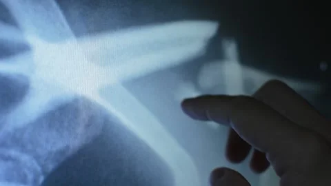 doctor's hand study an human x ray scan ... | Stock Video | Pond5