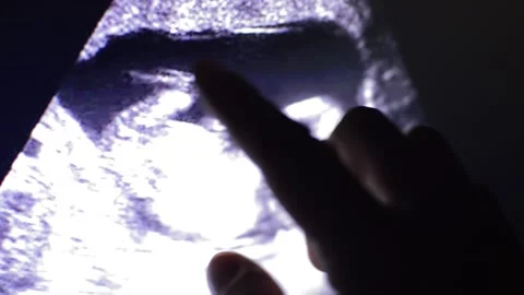 doctor's hand watch a mri scan of a baby... | Stock Video | Pond5