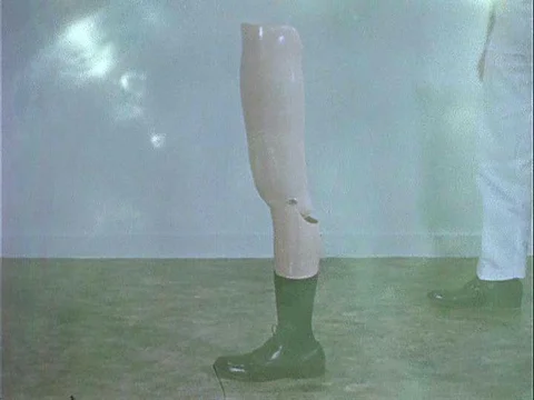 A double leg amputee patient is fitted h... | Stock Video | Pond5