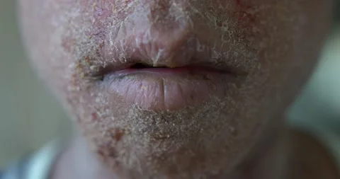 dry skin of an eczema patient | Stock Video | Pond5