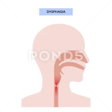 Dysphagia medical poster ~ Clip Art ~ Download #248090339