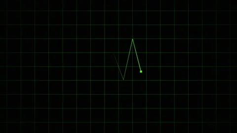 ecg graph on the monitor, Heartbeat Disp... | Stock Video | Pond5