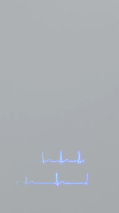 ECG graphs comparison of normal heart rh... | Stock Video | Pond5