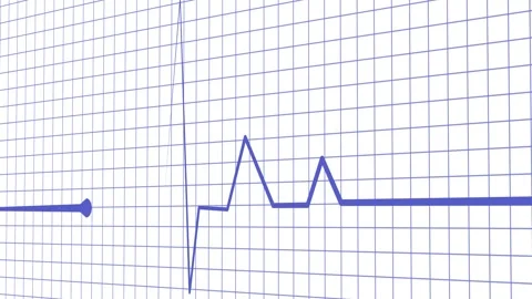 Electrocardiogram Background Stock Video Footage | Royalty Free ...