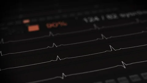 ECG waves on medical monitor loop animat... | Stock Video | Pond5