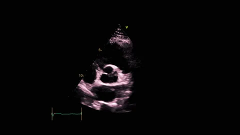 Echo heart beat imaging. Human heart ana... | Stock Video | Pond5