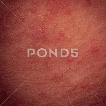 Eczema atopic dermatitis symptom skin texture Stock Photo #12179515