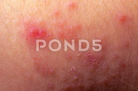 Eczema atopic dermatitis symptom skin texture ~ Hi Res #12260258