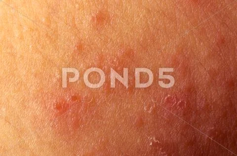 Eczema atopic dermatitis symptom skin texture Stock Photo #12260275