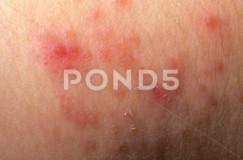 Eczema atopic dermatitis symptom skin texture ~ Hi Res #12266518