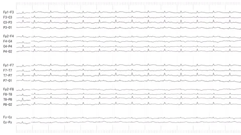 Brain Patient Stock Video Footage | Royalty Free Brain Patient Videos ...