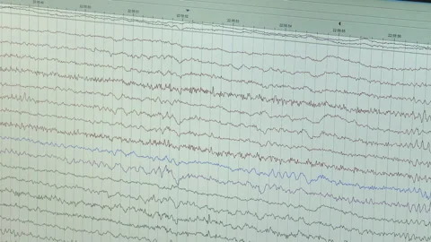 Abnormal Eegbrain Wave On