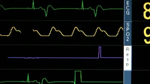 EKG Monitor Heart Failure Close up | Stock Video | Pond5