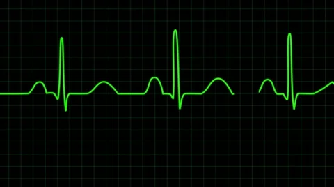 Electrocardiogram 2D animation | Stock Video | Pond5
