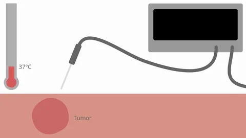 Electrosurgery Radiofrequency Ablation A... | Stock Video | Pond5