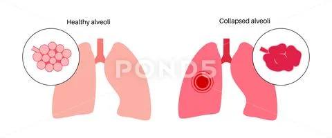 Emphysema anatomical poster Stock Illustration ~ #236728680