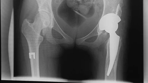 The Endoprosthesis of the Hip Joint on X... | Stock Video | Pond5