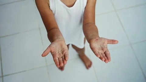 Enterovirus Leg - arm - mouth. Rash on t... | Stock Video | Pond5