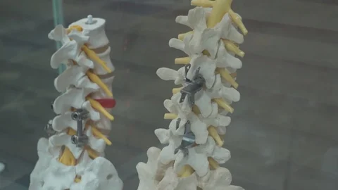 Example of human spine prosthetics with ... | Stock Video | Pond5