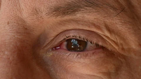 Eye infection, closeup of male eye with ... | Stock Video | Pond5