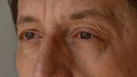 Eye infection, closeup of male eye with ... | Stock Video | Pond5