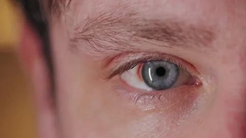 Eye injury Close up, blood in eye damage... | Stock Video | Pond5