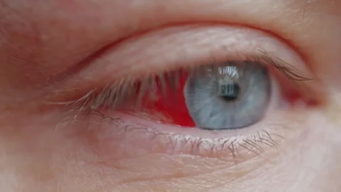 Eye injury Close up, blood in eye damage... | Stock Video | Pond5