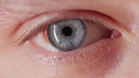 Eye injury Close up, blood in eye damage... | Stock Video | Pond5