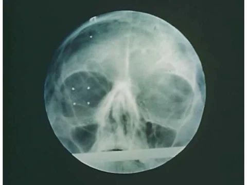 Intra Ocular Foreign Bodies Stock Videos – Royalty-Free HD & 4K Videos ...