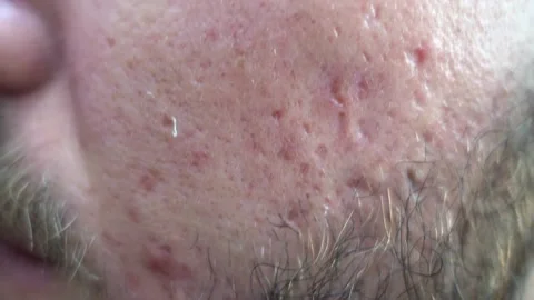 Skin Inflammation Stock Videos – Royalty-Free HD & 4K Videos