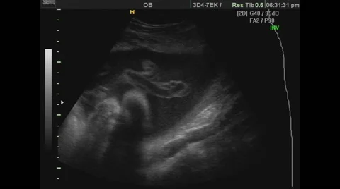 fetal ultrasound 2D foot with text | Stock Video | Pond5