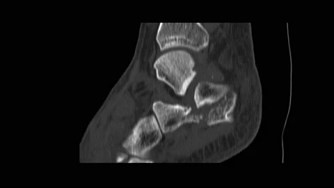 Film CT Scan foot showing heel bone brok... | Stock Video | Pond5
