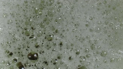 Foaming and foamy urine caused by kidney... | Stock Video | Pond5