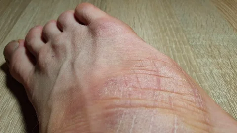Foot disease. Foot skin disease. Skin di... | Stock Video | Pond5