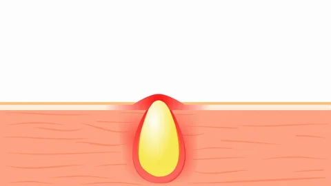 Pimple Stock Footage ~ Royalty Free Stock Videos | Pond5