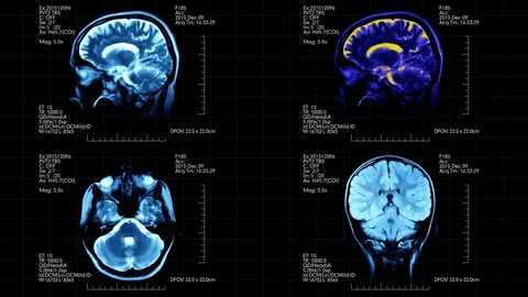 Four different pictures of MRI brain sca... | Stock Video | Pond5