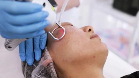 Co2 Fractional Laser Stock Video Footage | Royalty Free Co2 Fractional ...