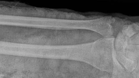 Wrist Fracture Xray Stock Video Footage | Royalty Free Wrist Fracture ...