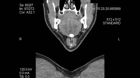 Front Coronal plane tomography: CT scan ... | Stock Video | Pond5