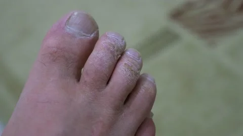 fungal calluses on the toes, itchy foot ... | Stock Video | Pond5