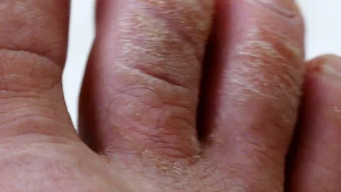 fungi occurring in the toes, foot fungal... | Stock Video | Pond5