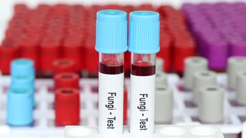 Fungi test, blood sample to analyze in t... | Stock Video | Pond5