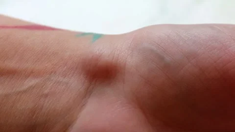 A ganglion cyst is a benign cystic tumor... | Stock Video | Pond5