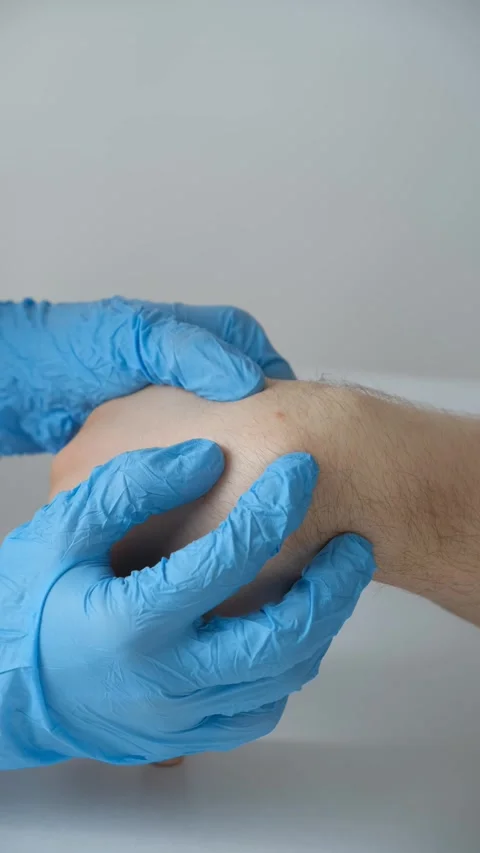 Ganglion cyst or hygroma of the wrist on... | Stock Video | Pond5