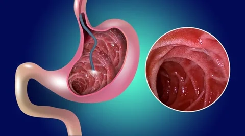 Endoscopy Images Stomach
