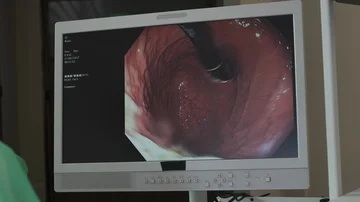 Gastroscopy Stock Footage ~ Royalty Free Stock Videos | Pond5