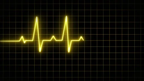 GIF Animation of an ECG showing atrial f... | Stock Video | Pond5
